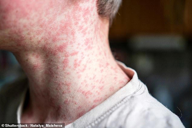 Health chiefs warn of 'rapid rise' in deadly measles in parts of UK