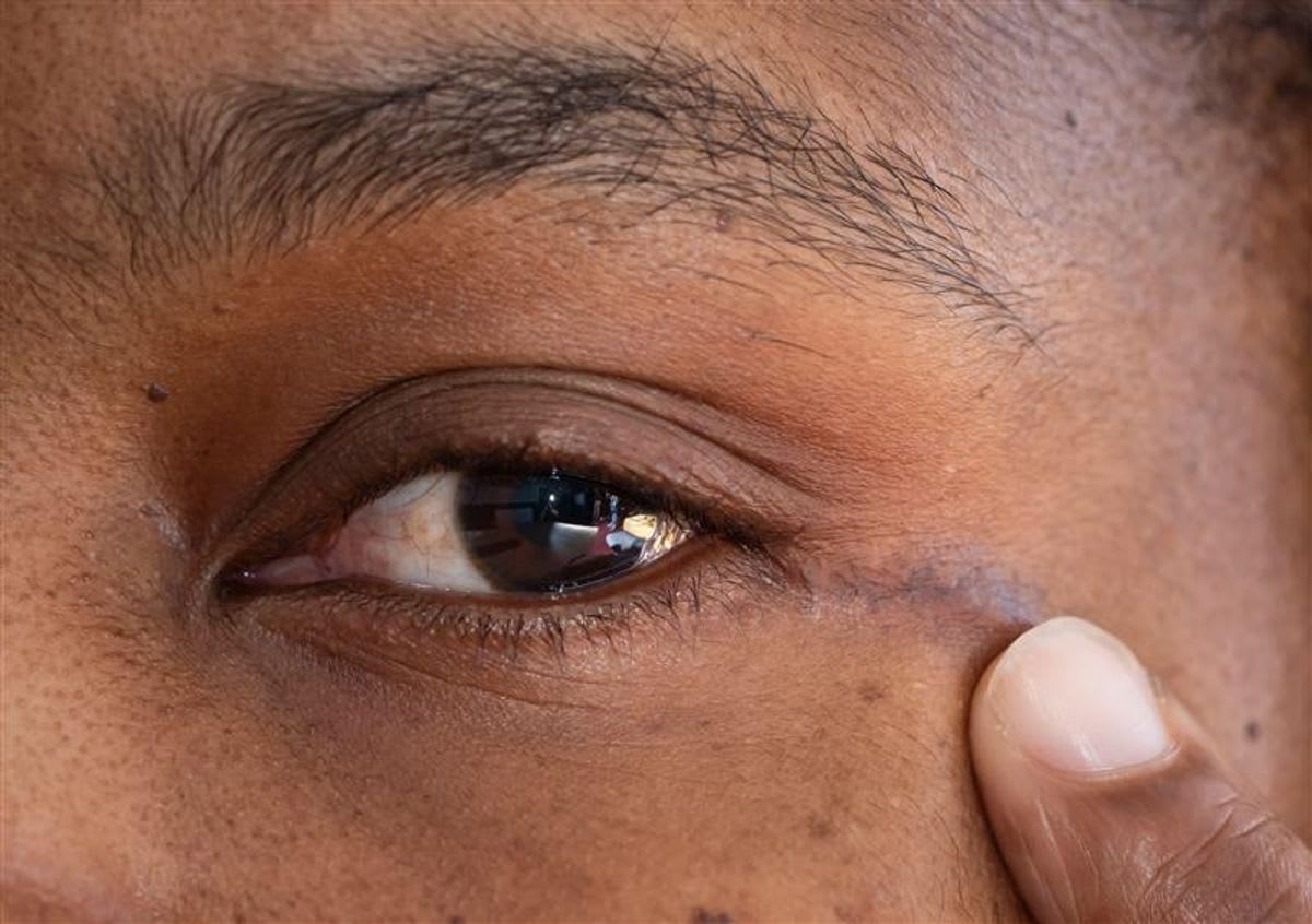 "Inaccessible" Tumor Removed Through Eye Socket In UK's First Surgery ...