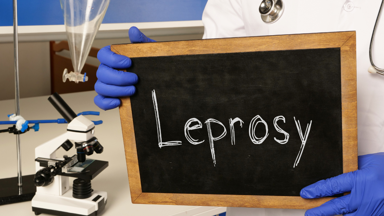 Leprosy Unmasked: Expert Debunks Common Myths and Reveals the Facts ...