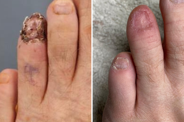 Man Finds Faint Brown Line on Toenail, Turns Out To Be Cancer