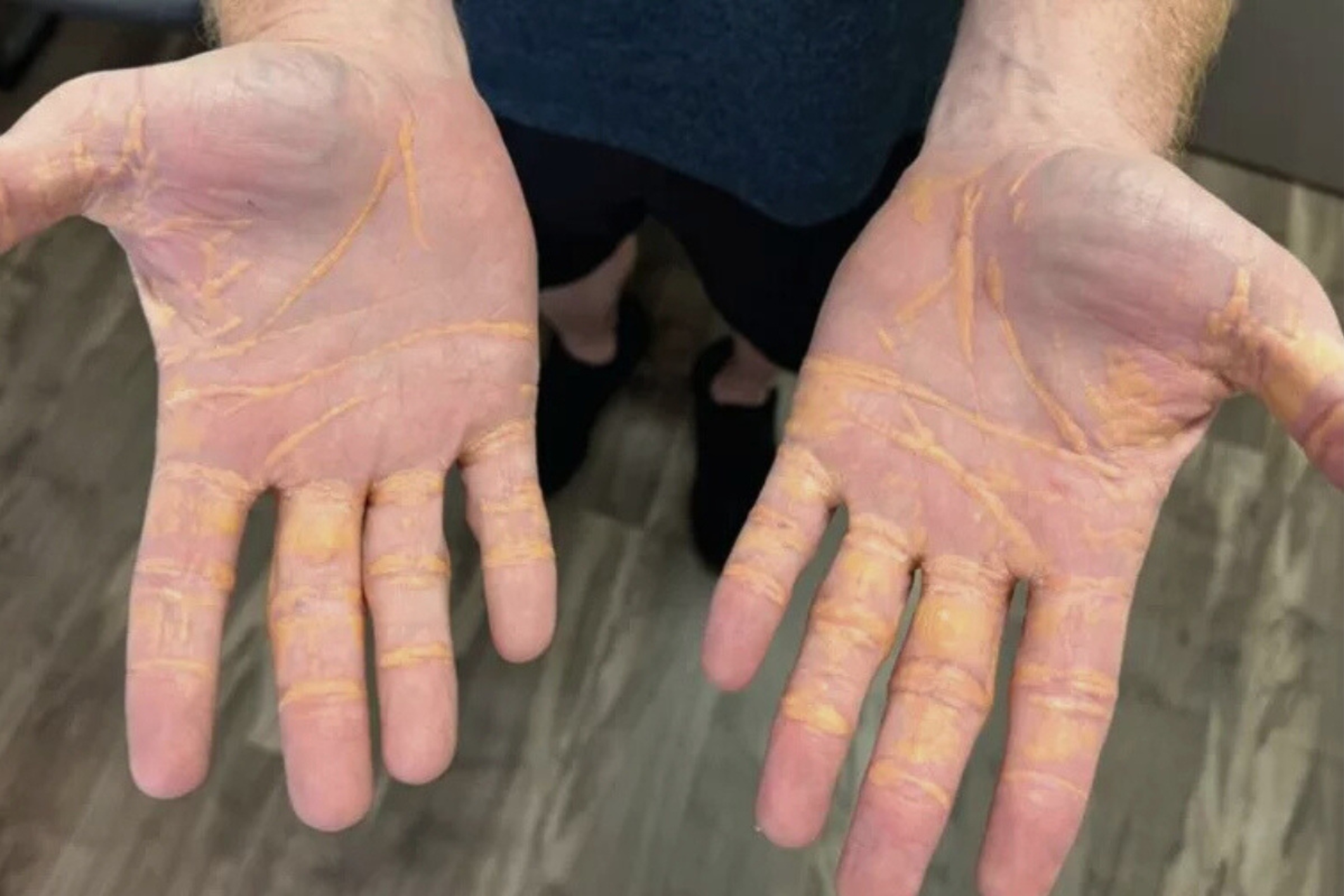 Man hospitalised after carnivore diet made cholesterol ooze from his ...