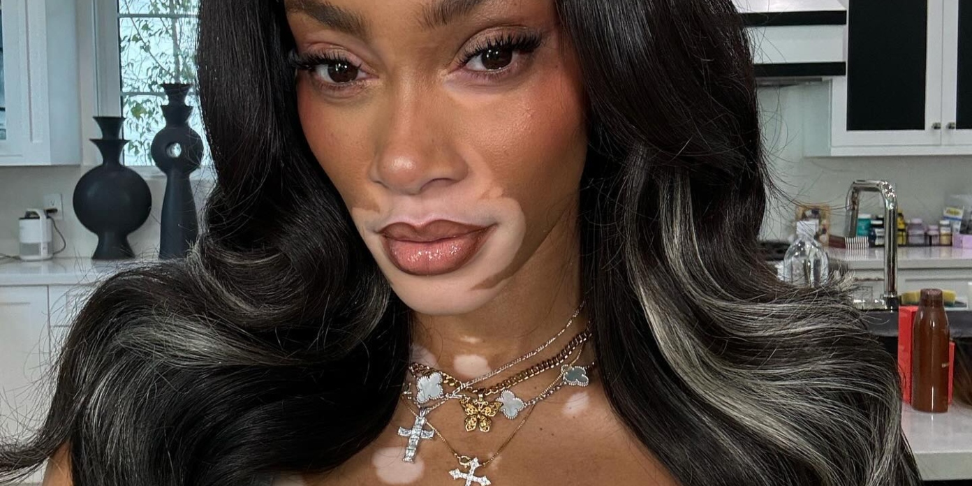 What is the skin disease of this 30-year-old model?