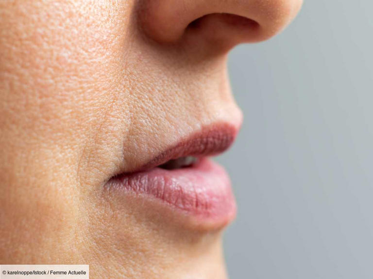 Comment atténuer les rides autour des lèvres sans chirurgie