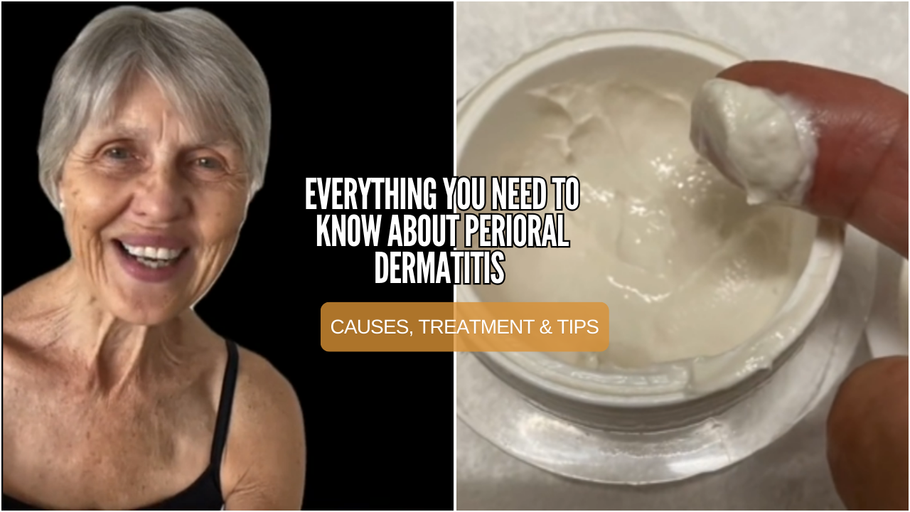 Everything You Need to Know About Perioral Dermatitis | Causes ...