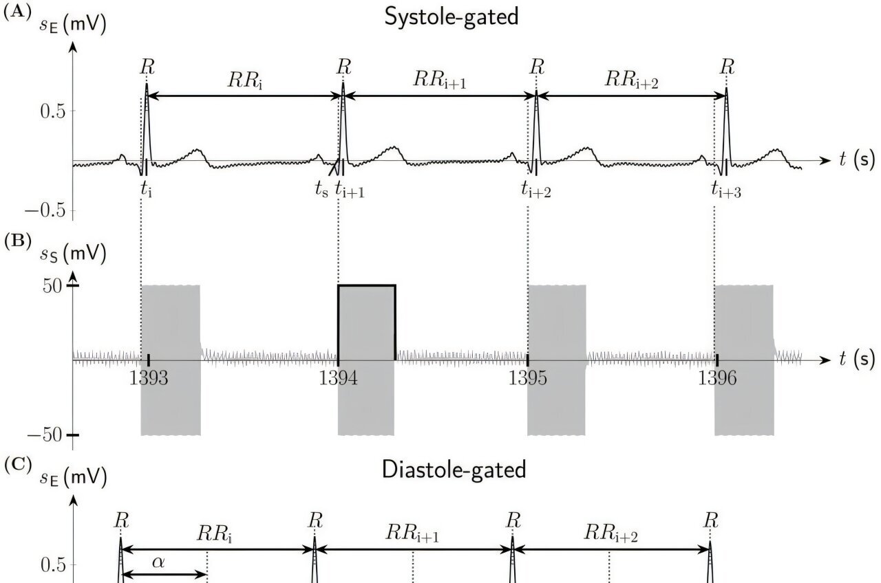 Nerve stimulation therapy can be improved by synchronization with the ...