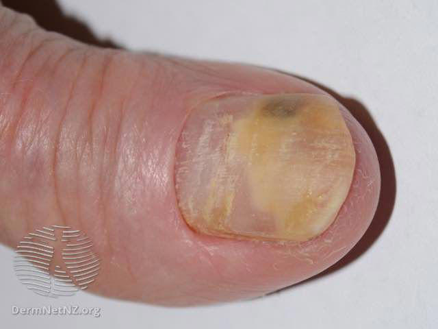 What loose nails mean and how to treat them