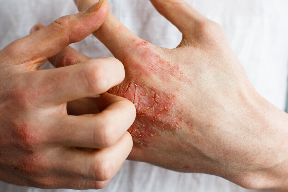 AI Can Tell How Bad Your Eczema Really Is From Just One Photo