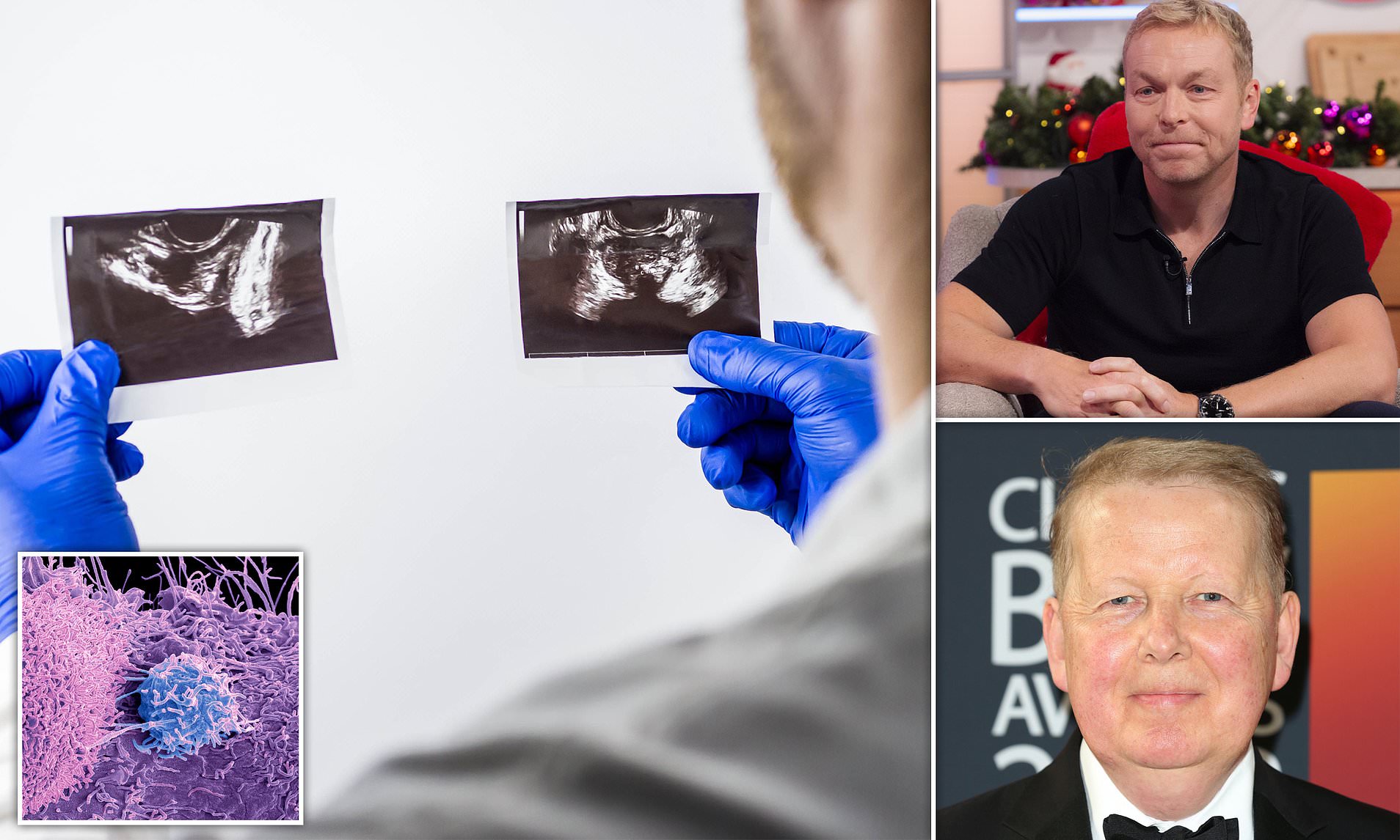 Prostate cancer becomes the most diagnosed cancer in the country