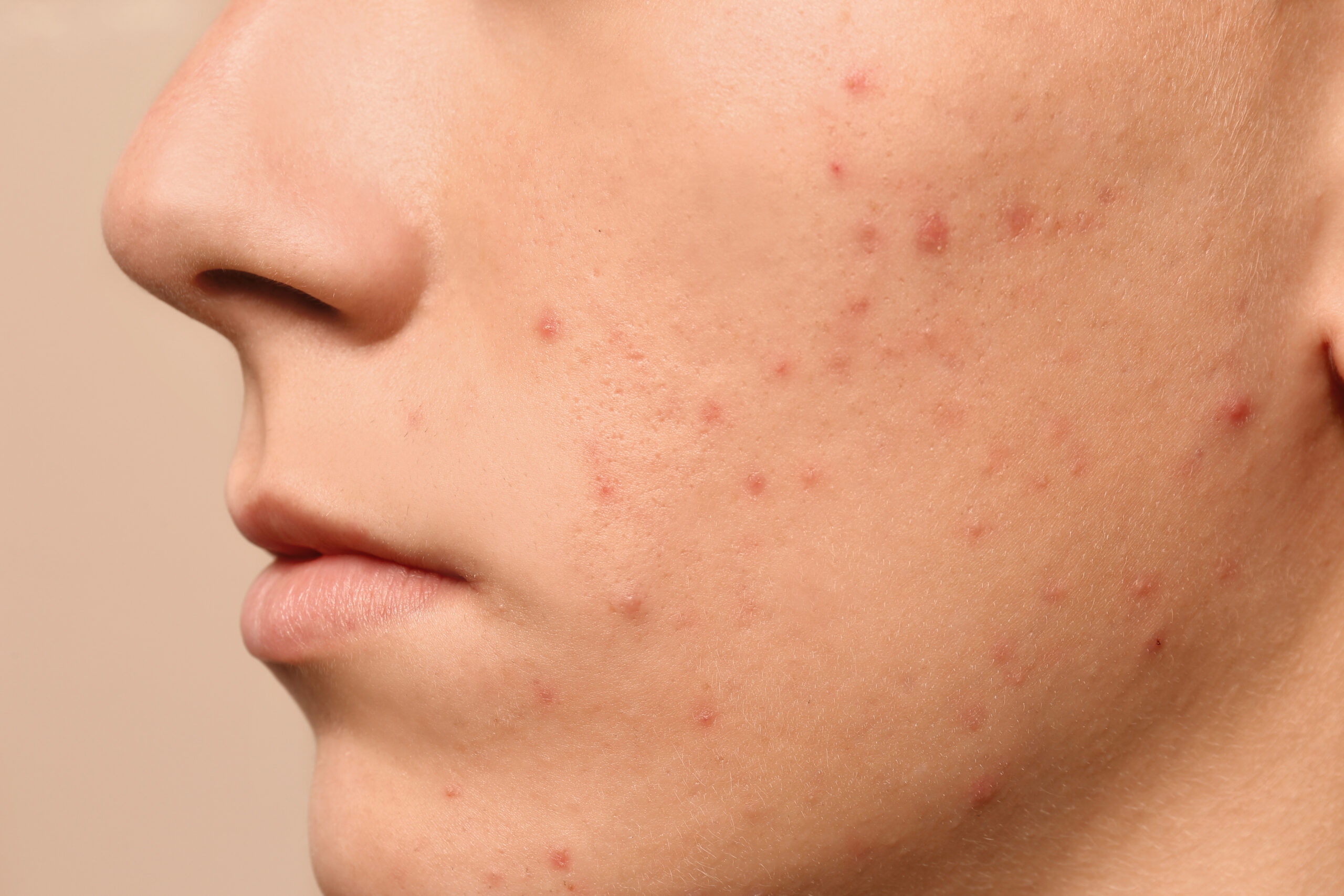 Clearing Up Acne: How a Simple Skincare Routine Can Make a Difference