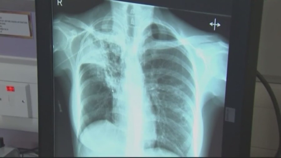 Kansas officials say risk is low after tuberculosis outbreak