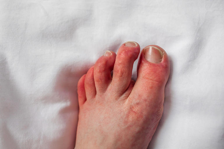 Eight ways your feet can tell you if you are unhealthy