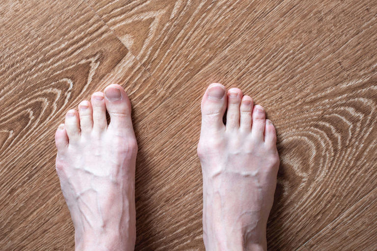 Eight ways your feet can tell you if you are unhealthy