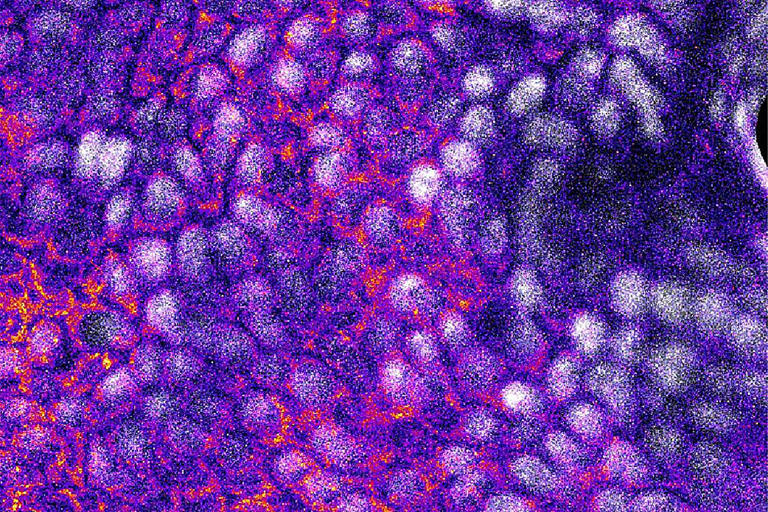 Tracking the metabolic origins of cancer from a mosaic of cells