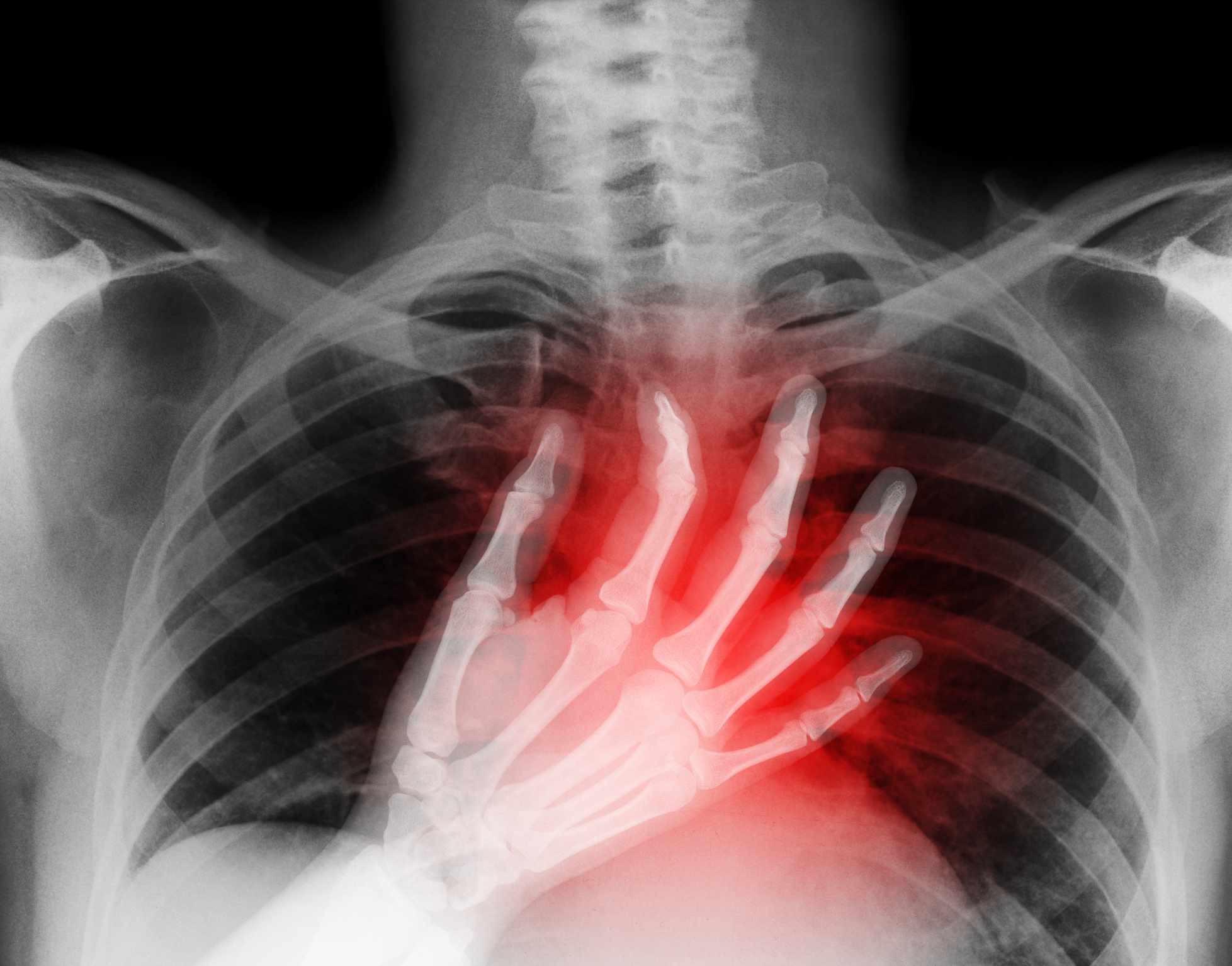 Costochondritis symptoms, causes, and treatment