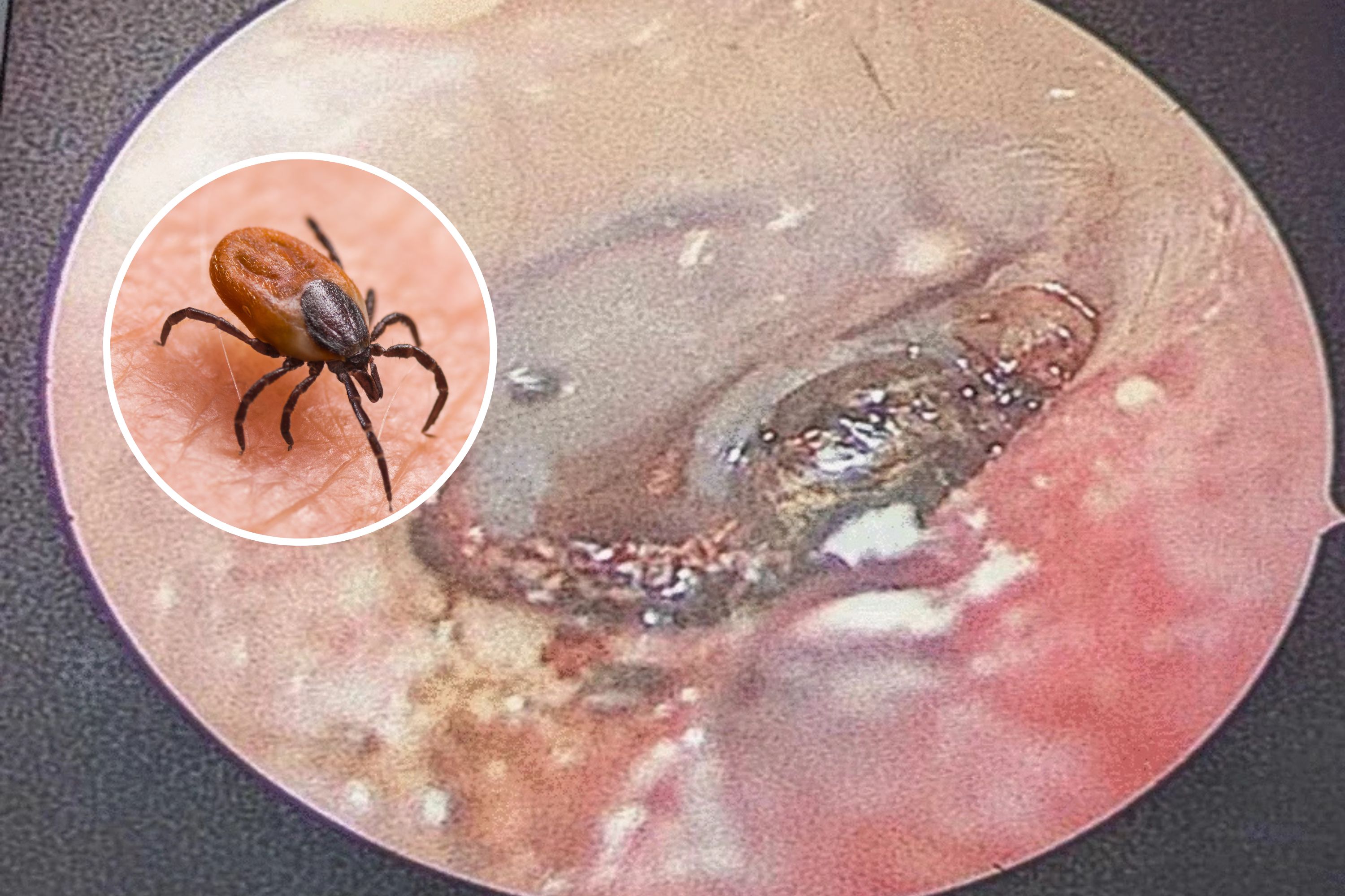 Parasite Stuck in Woman's Ear Causes 'Piercing' Pain and Deafness