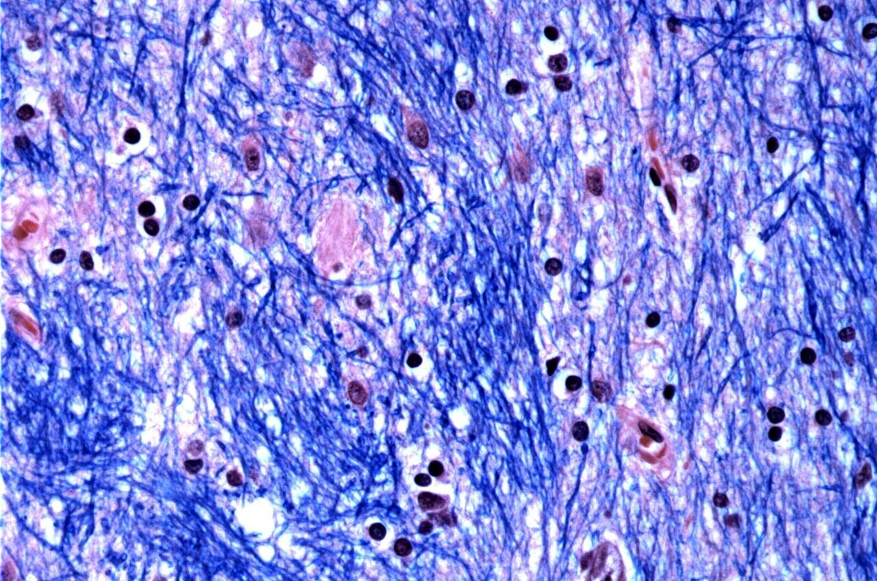 Surprising way that genetic mutation causes Huntington's disease ...