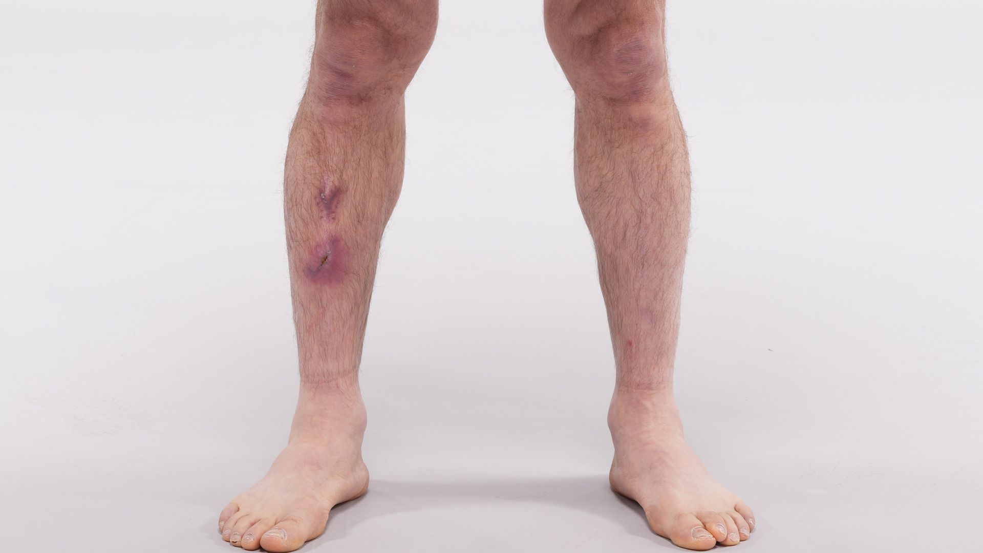 Merab Is Injured, But ‘It’s All Good’