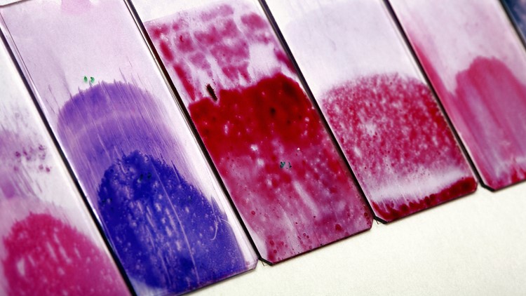 New treatment combinations improving cervical cancer outcomes, doctors say