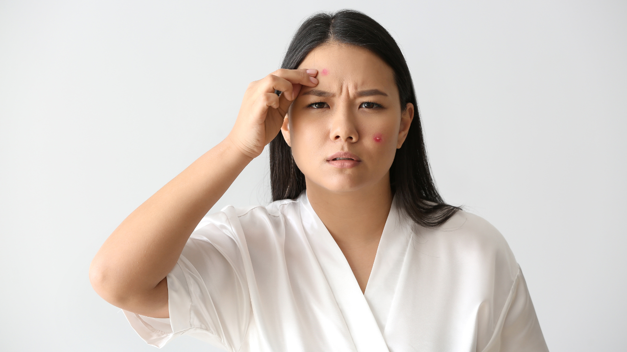 Decoding the acne map: What you pimples and breakouts say about your health