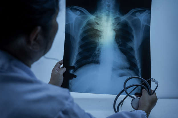 Everything you need to know about lung cancer Everything you need to know about lung cancer
