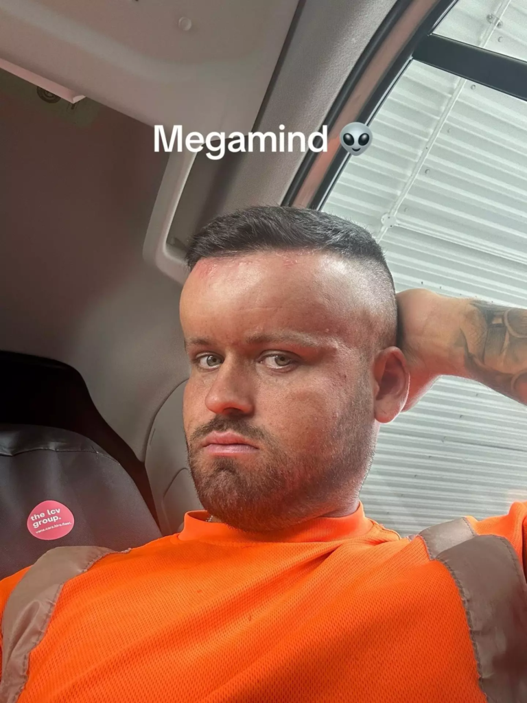 Man Ends Up Looking Like ‘Megamind' After Having Intense Reaction To ...