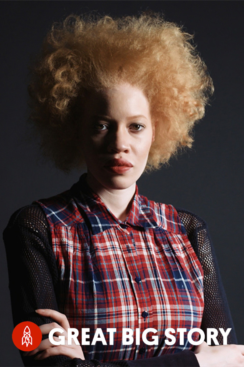 Breaking barriers, a model with albinism shares her story
