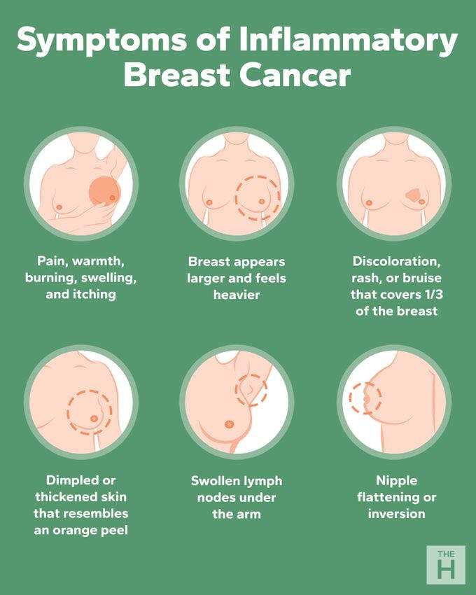 What Is a Breast Cancer Rash? A Doctor Explains