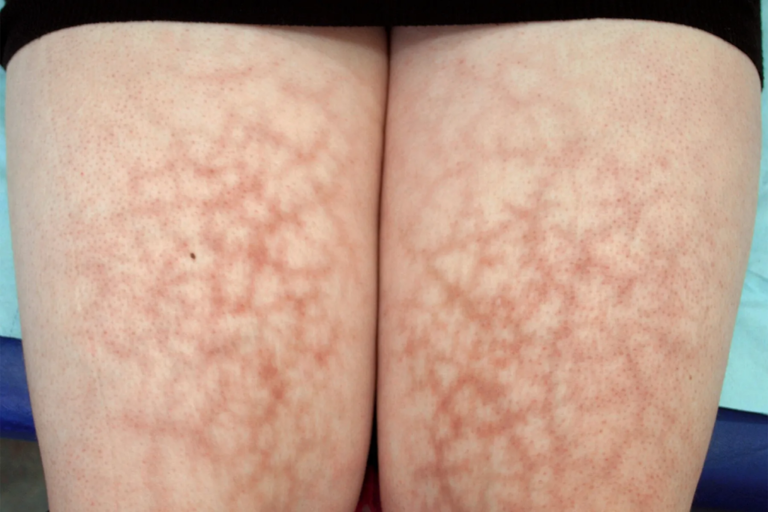 Heating Pads and Blankets Linked to ‘Toasted Skin Syndrome,' Experts ...
