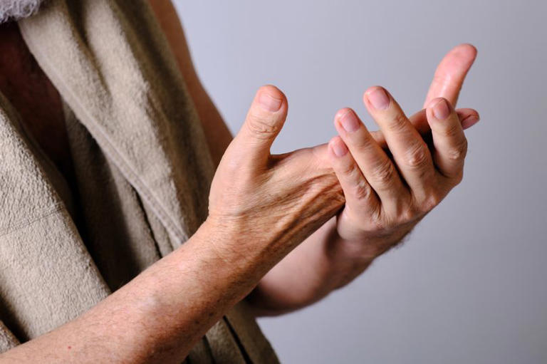 Check your hands for these three signs that could indicate severe liver ...