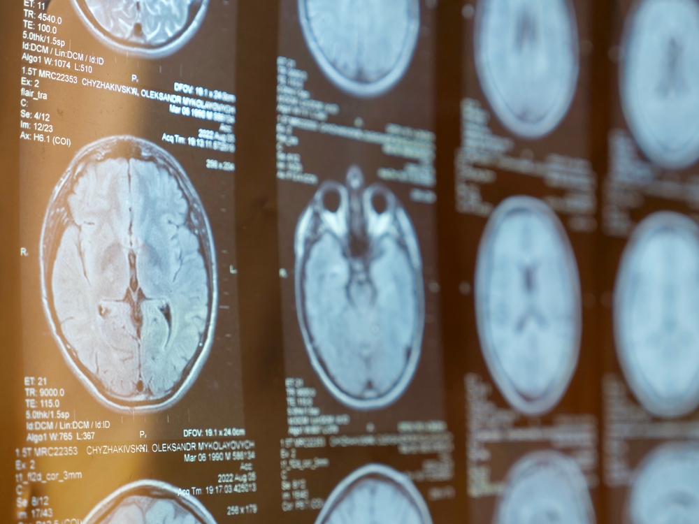 Common vitamin shows promise against deadly brain cancer