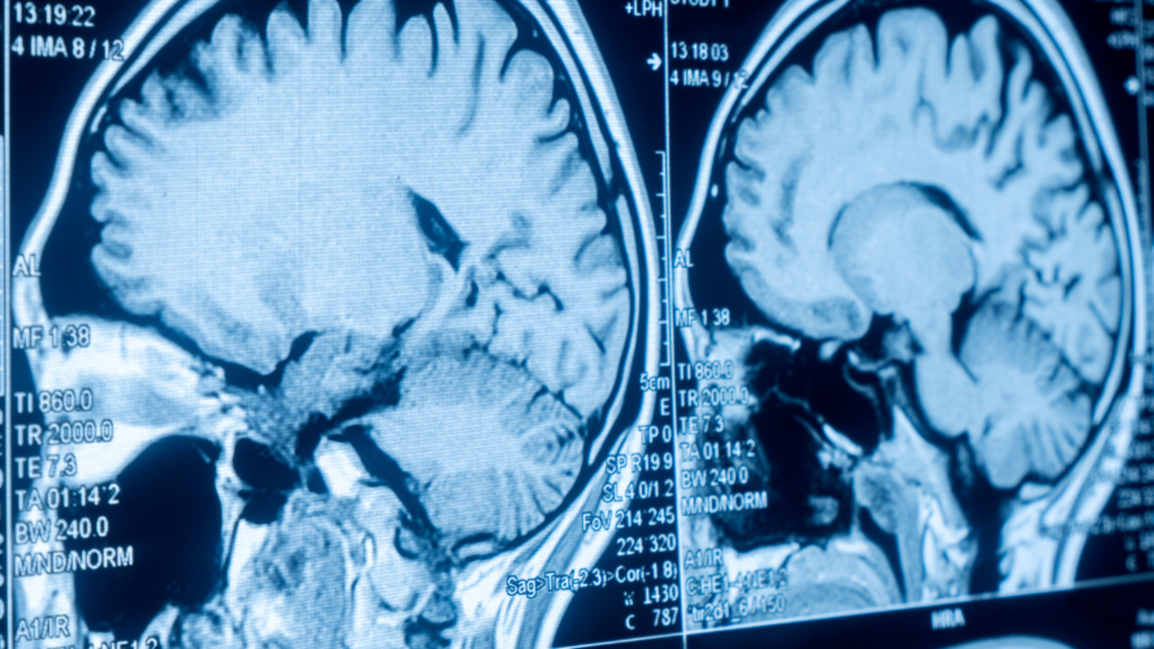 Breakthrough Study Reveal What Triggers Huntington's Disease ...