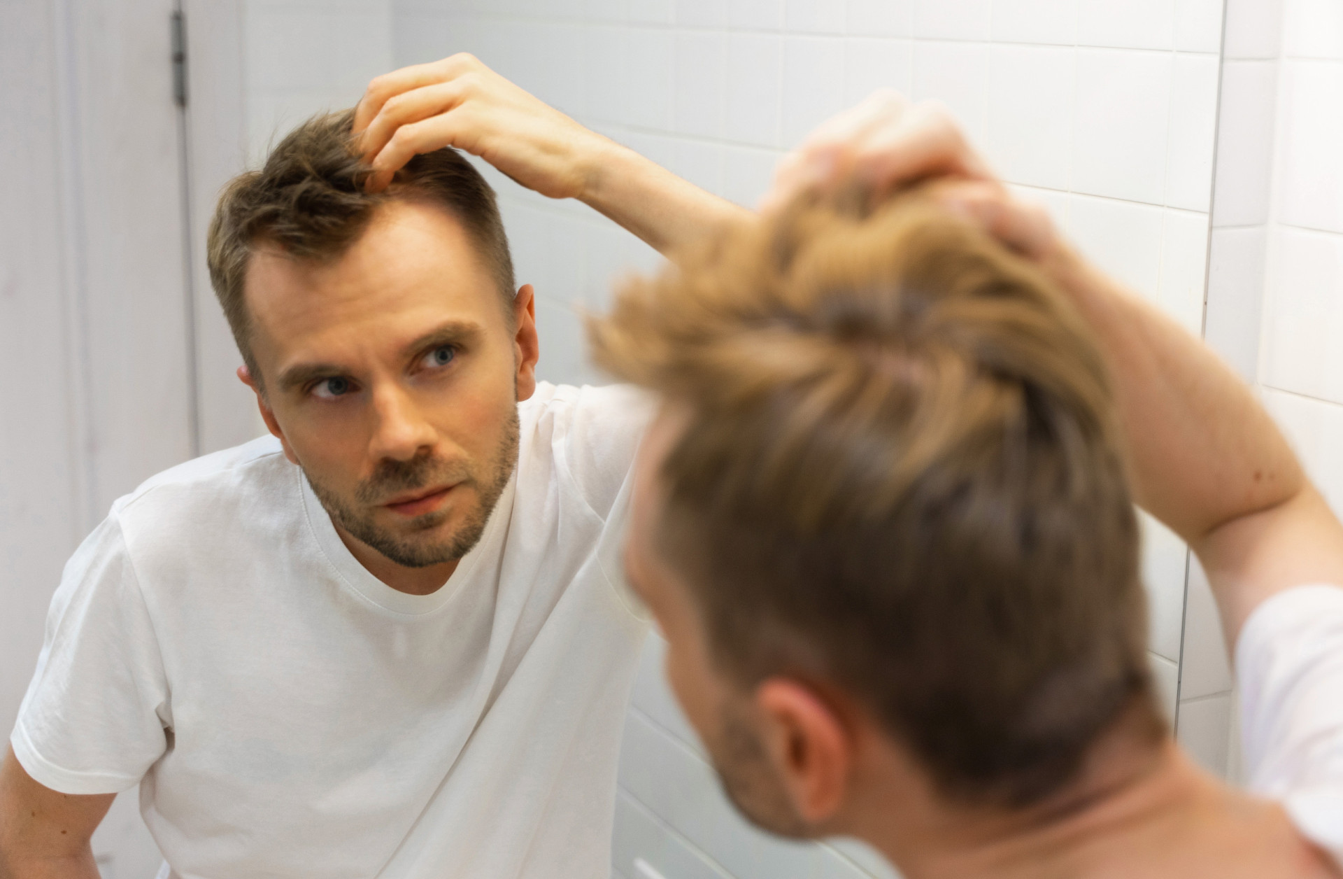 Which countries have the most bald men?