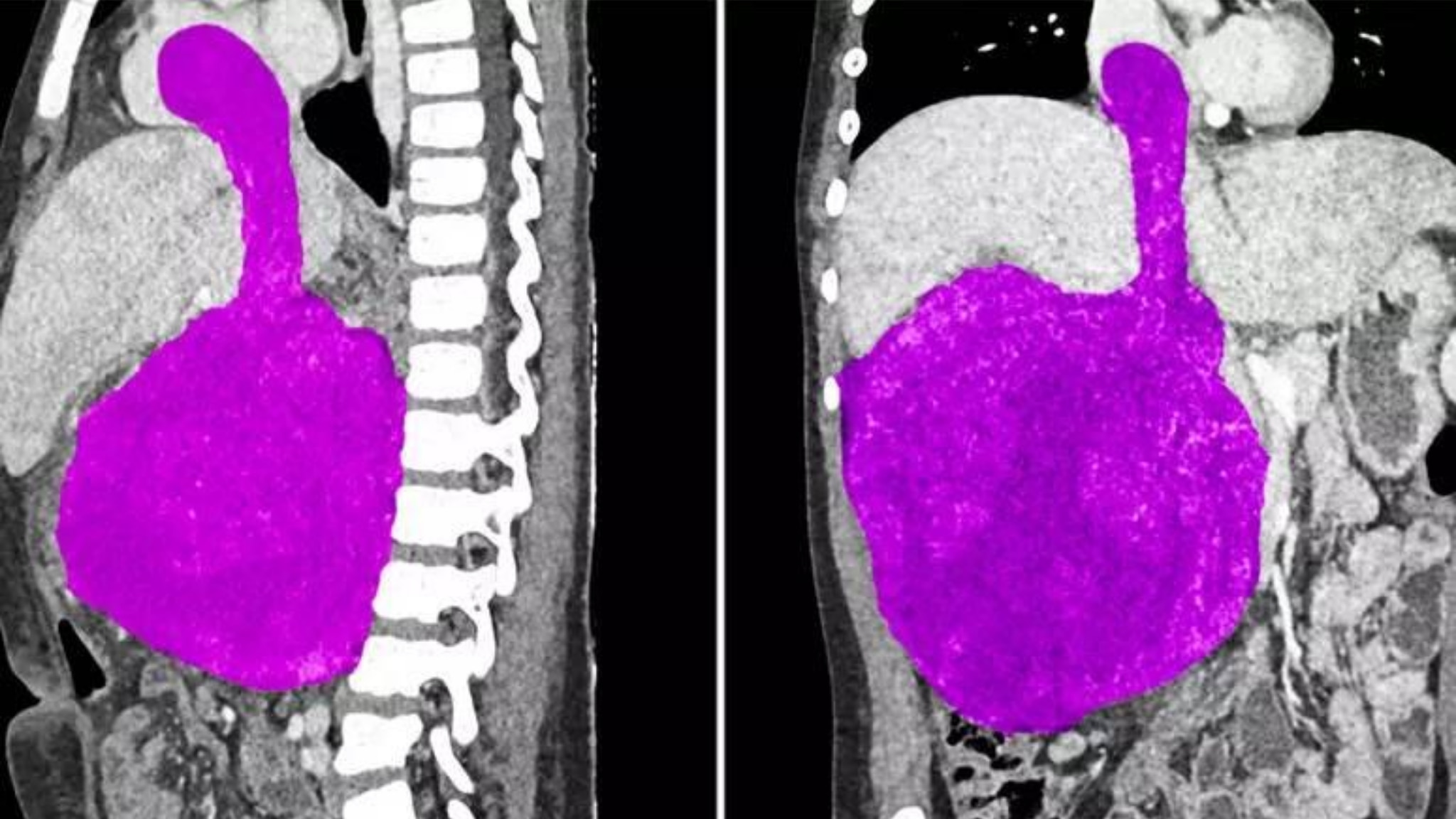 Rimosso un tumore al rene grande fino al cuore in una bimba di 8 anni