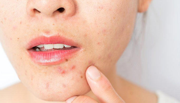 4 Most Common Skin Problems and Their Home Remedies