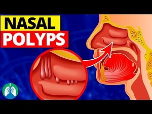 Nasal Polyps (Medical Definition) | Quick Explainer Video