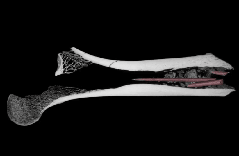 University re-examines 7,000-year-old femur, discovers oldest multi ...