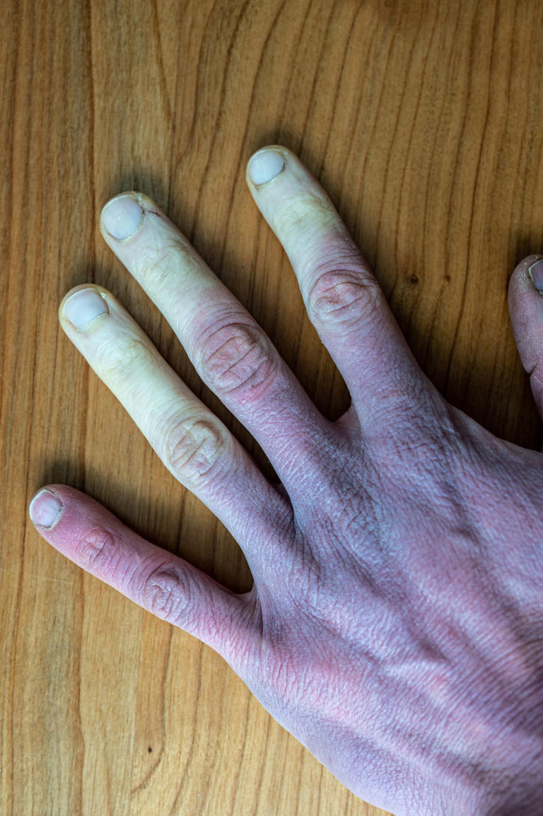 Feet and hands go numb in the cold? How to know if it’s Raynaud’s or ...