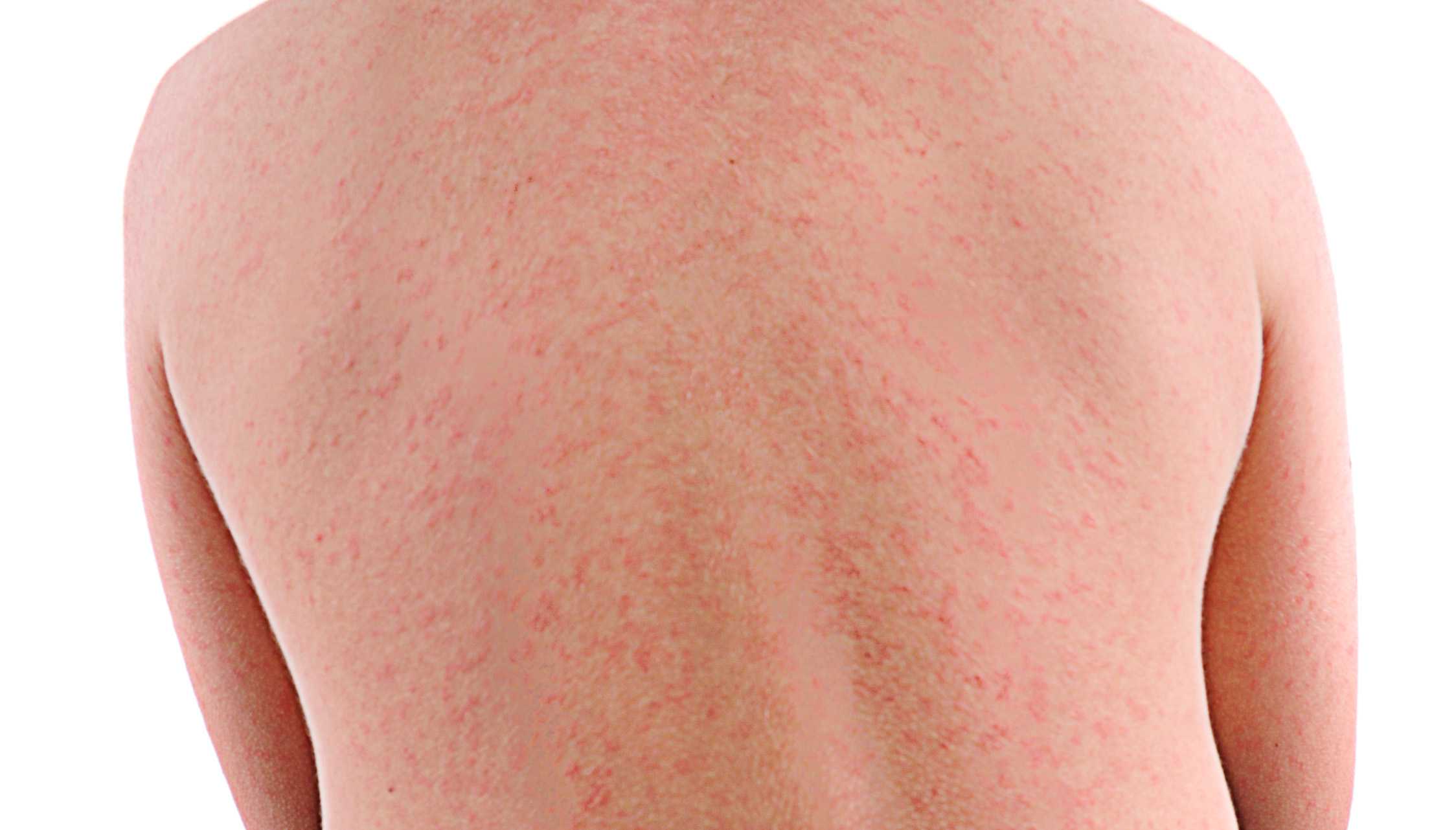 Health officials confirm measles case in Beaufort County with exposures ...