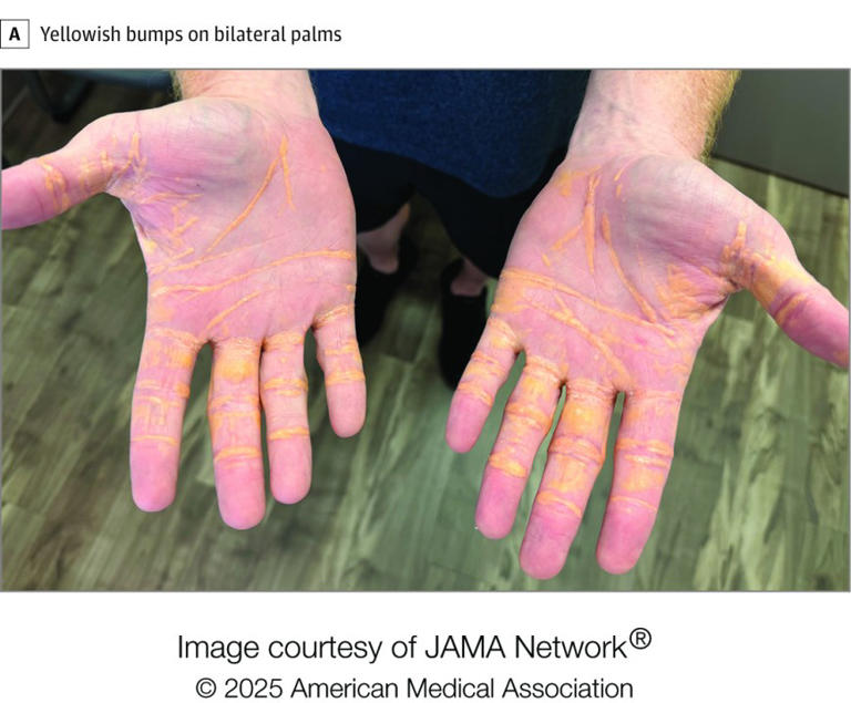 TGH patient’s hands filled with cholesterol after he ate 6-9 pounds of ...