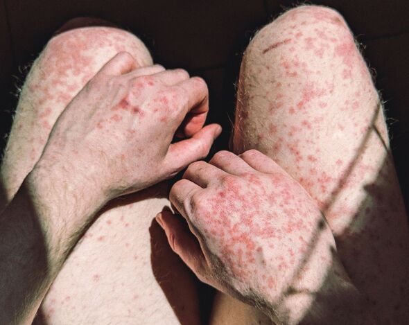 Health chiefs issue alert over 'highly infectious' disease spreading ...