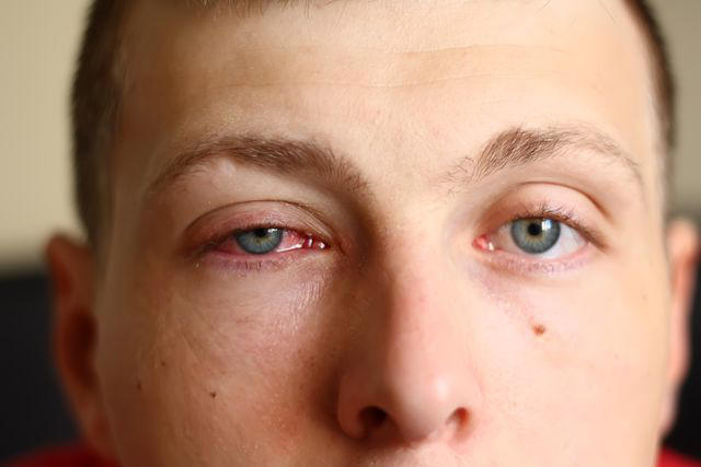 8 Reasons Why You Have Crusty Eyes, and What To Do About It