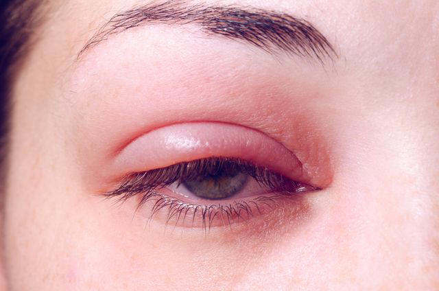 8 Reasons Why You Have Crusty Eyes, and What To Do About It