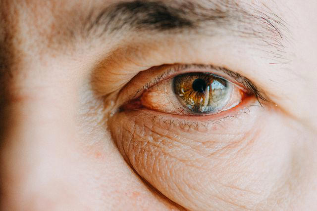 8 Reasons Why You Have Crusty Eyes, and What To Do About It