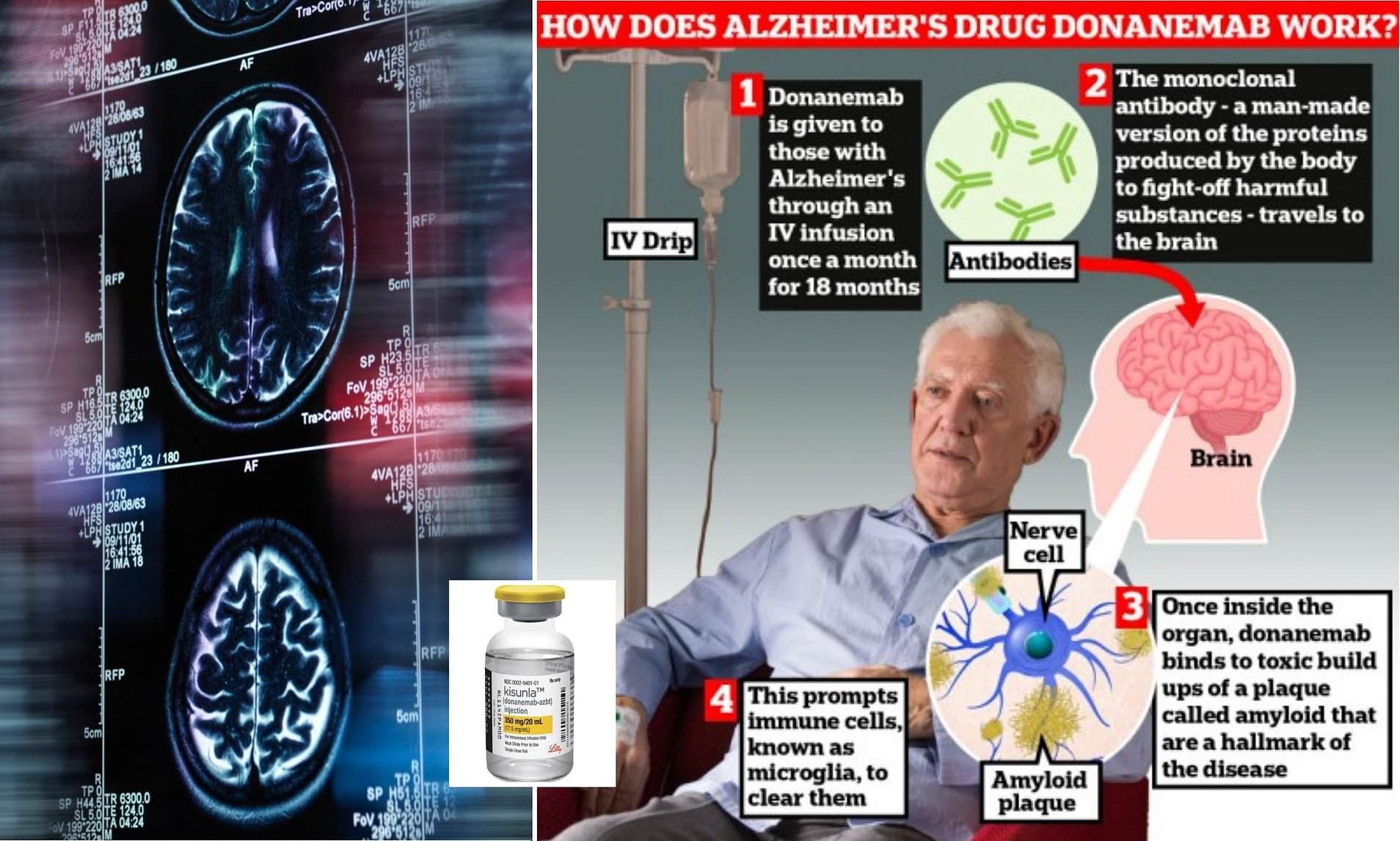 Miracle Alzheimers drug donanemab goes on sale in private clinics