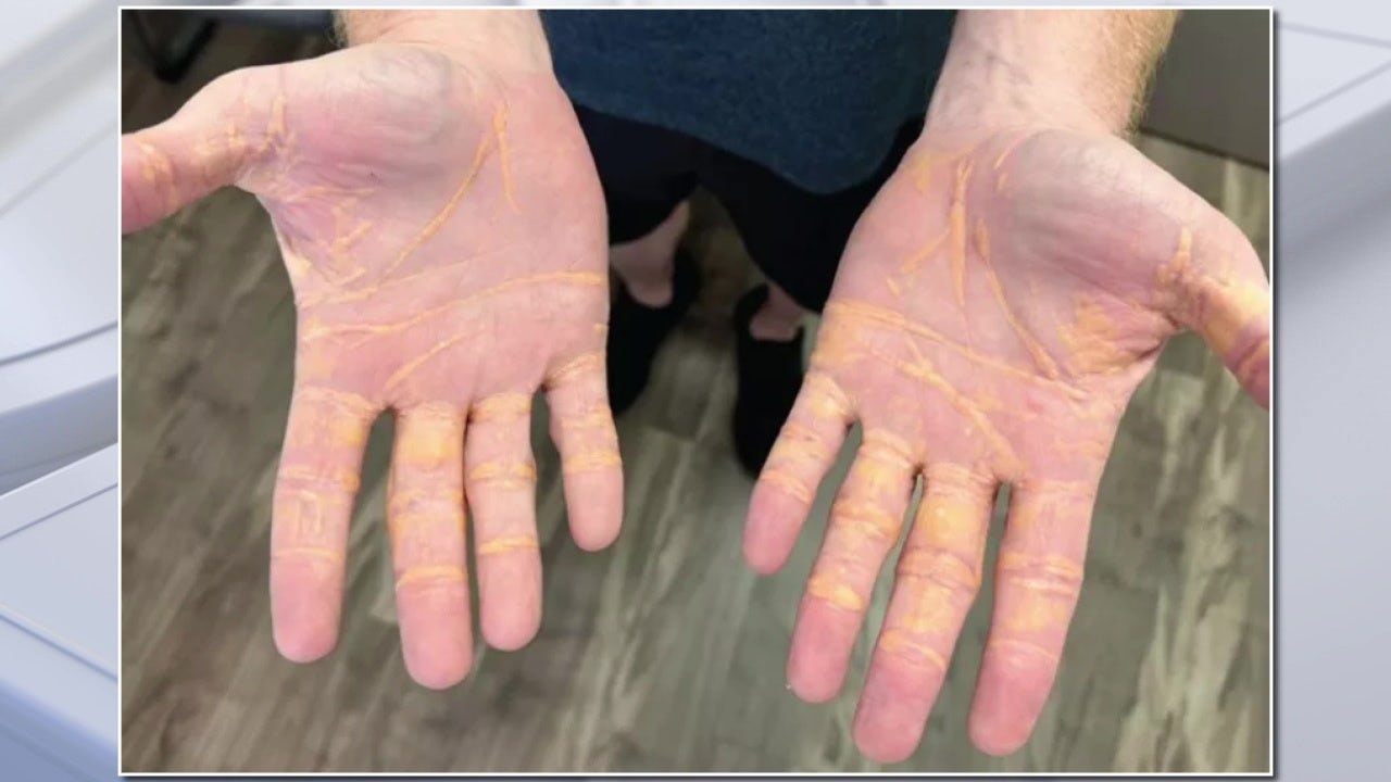 Man eating 6-9 pounds of butter and cheese a day develops ‘cholesterol ...