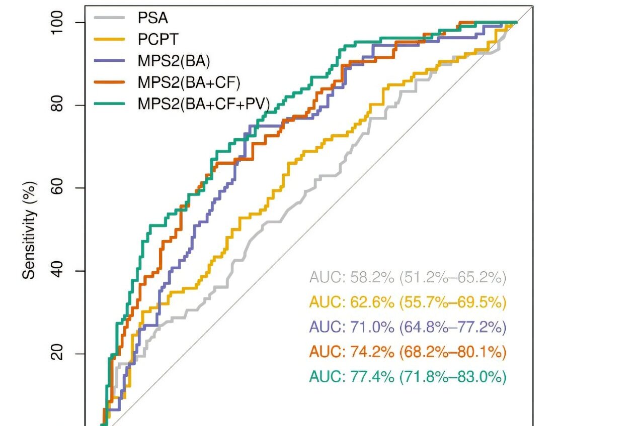 Urine-based test detects aggressive prostate cancer