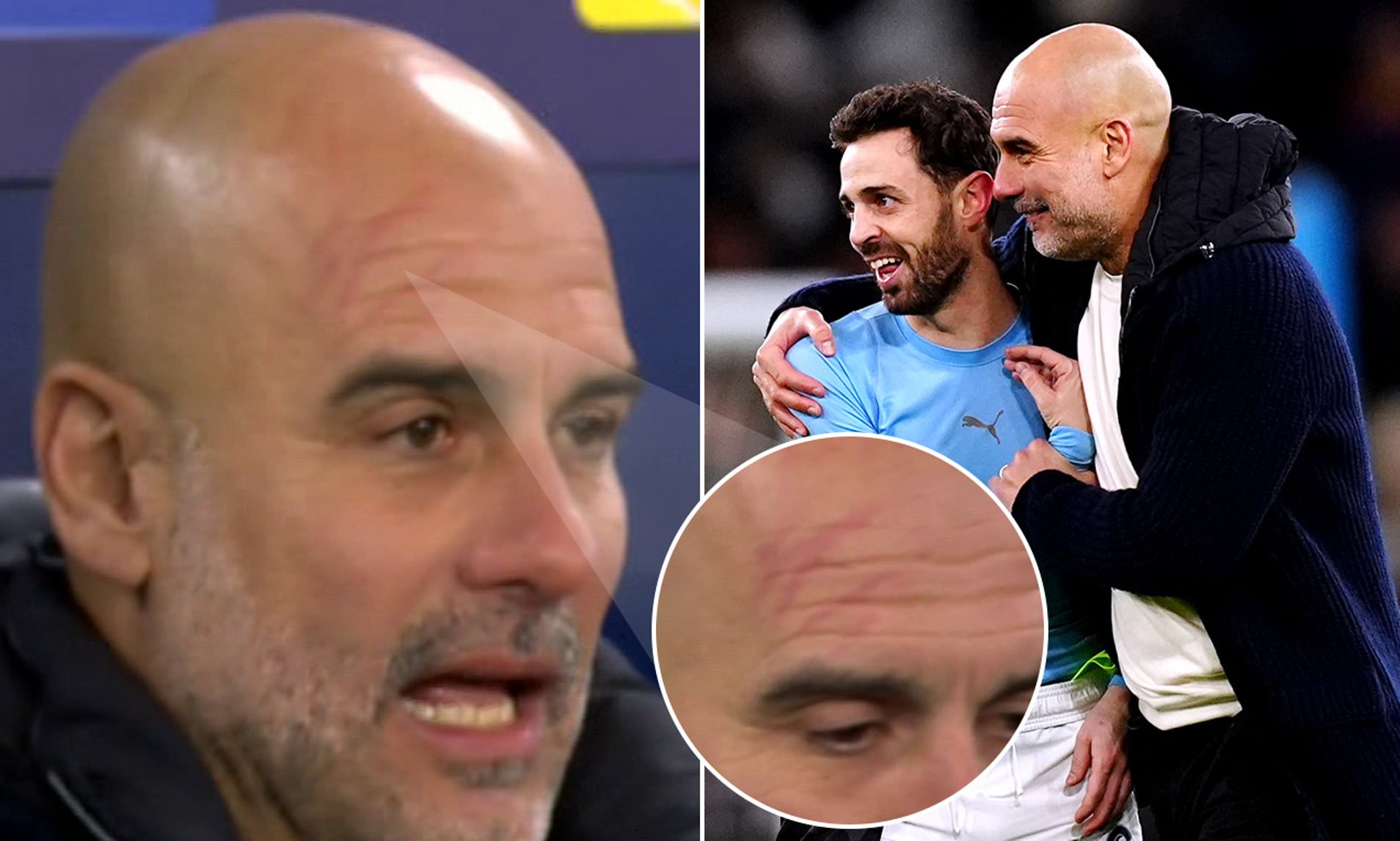 Pep Guardiola spotted with scratches on his head AGAIN as his ...