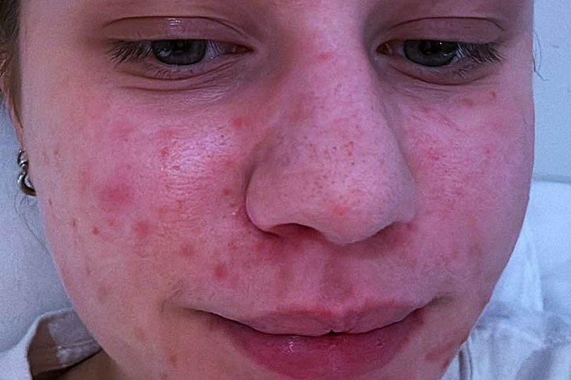 'I was called pizza face at school due to acne before one moment ...
