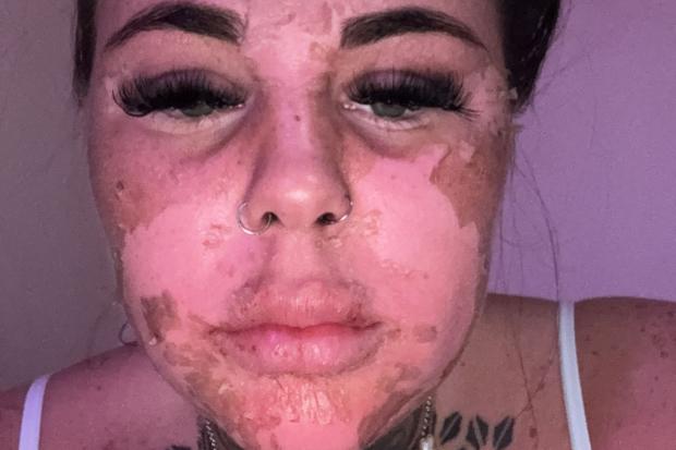 Warning to sunbed users after 'dangerous' trick burnt skin off woman's face