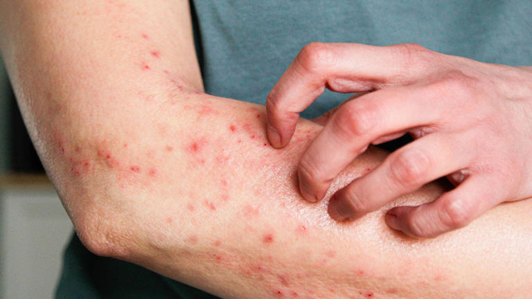 The 7 Types of Eczema: Symptoms And Causes